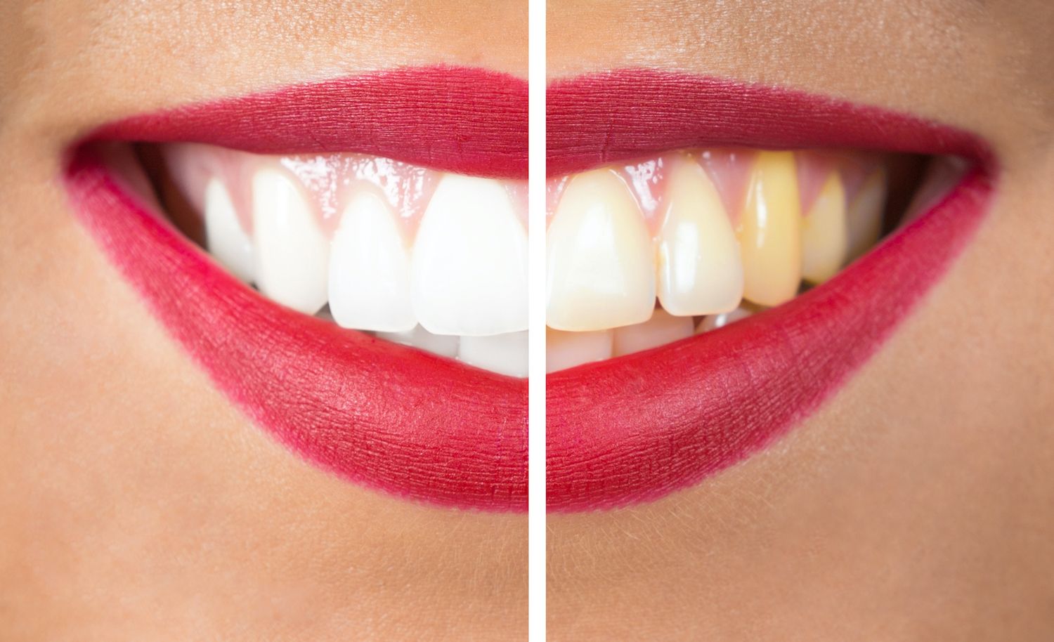 Benefits of a Professional Whitening - Dentist in Nashville, TN